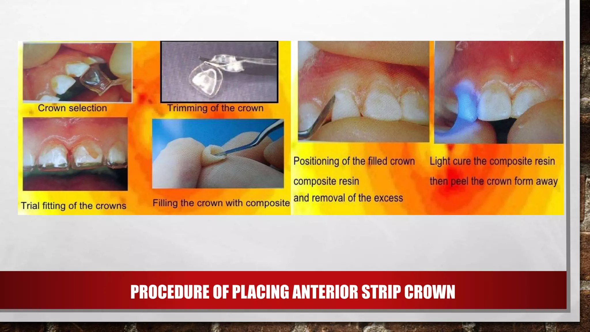 Anterior strip crown | PPTX