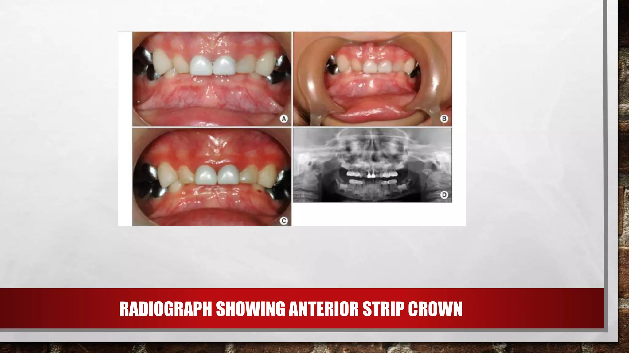 Anterior strip crown | PPTX