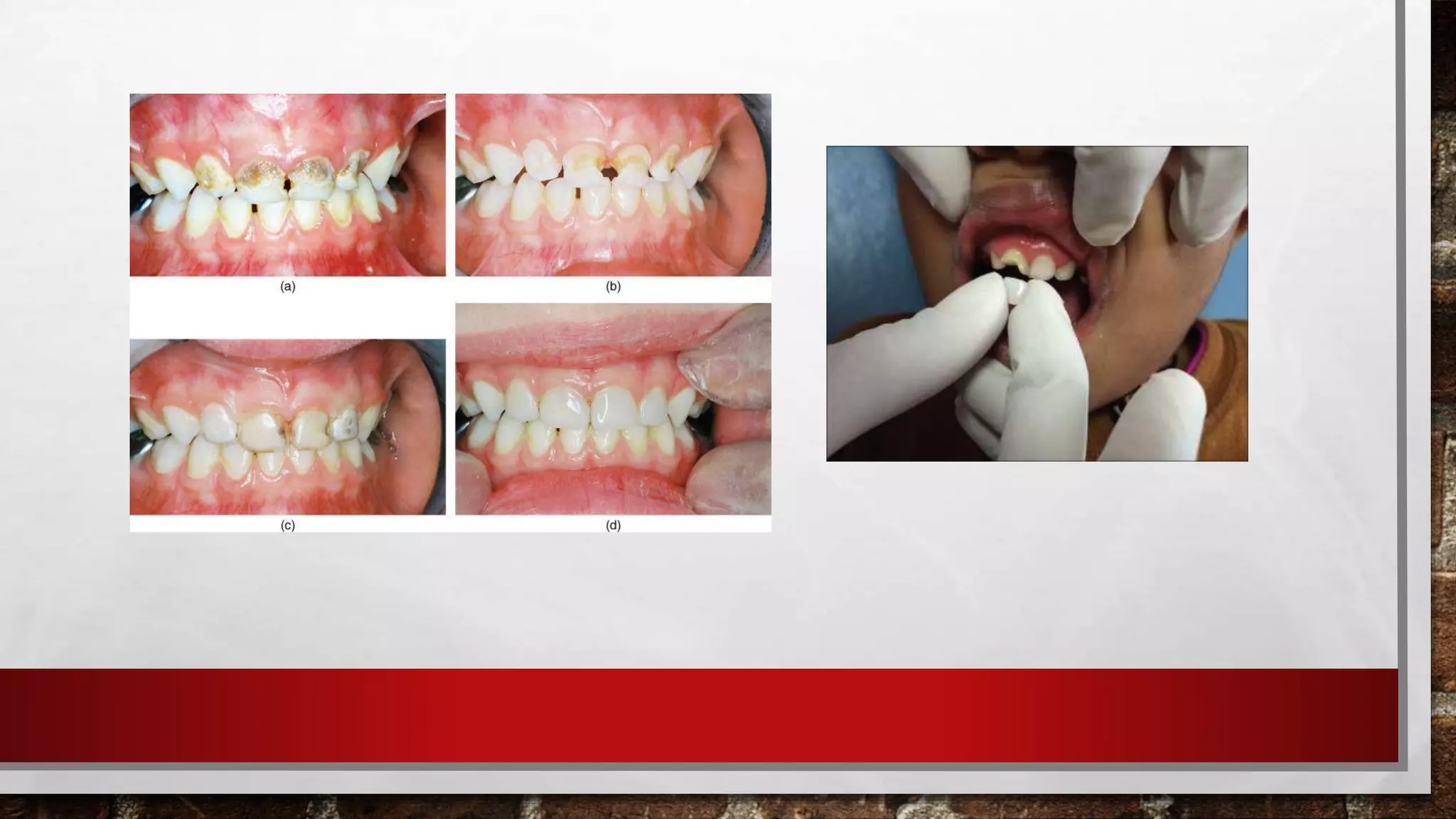 Anterior strip crown | PPTX