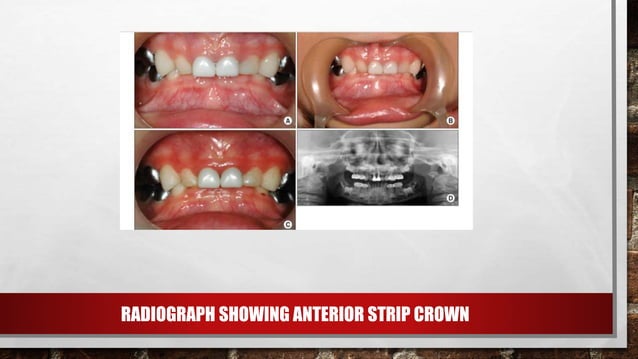 Anterior Strip Crown Ppt