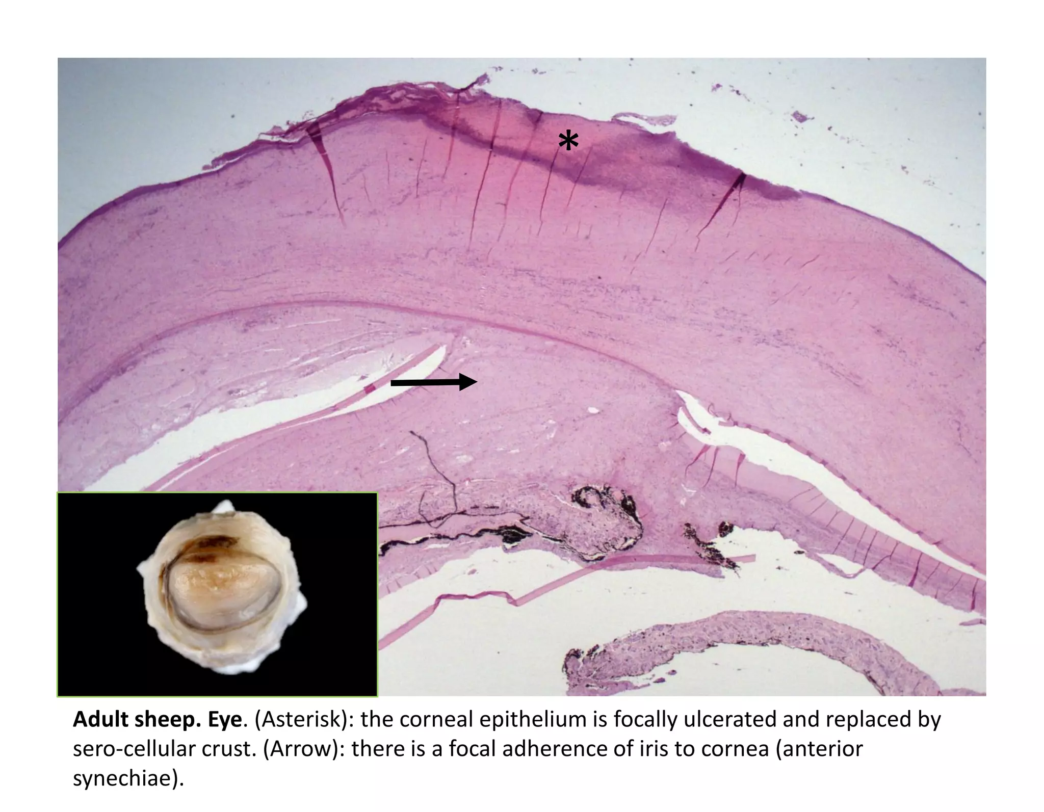 Anterior synechiae | PDF