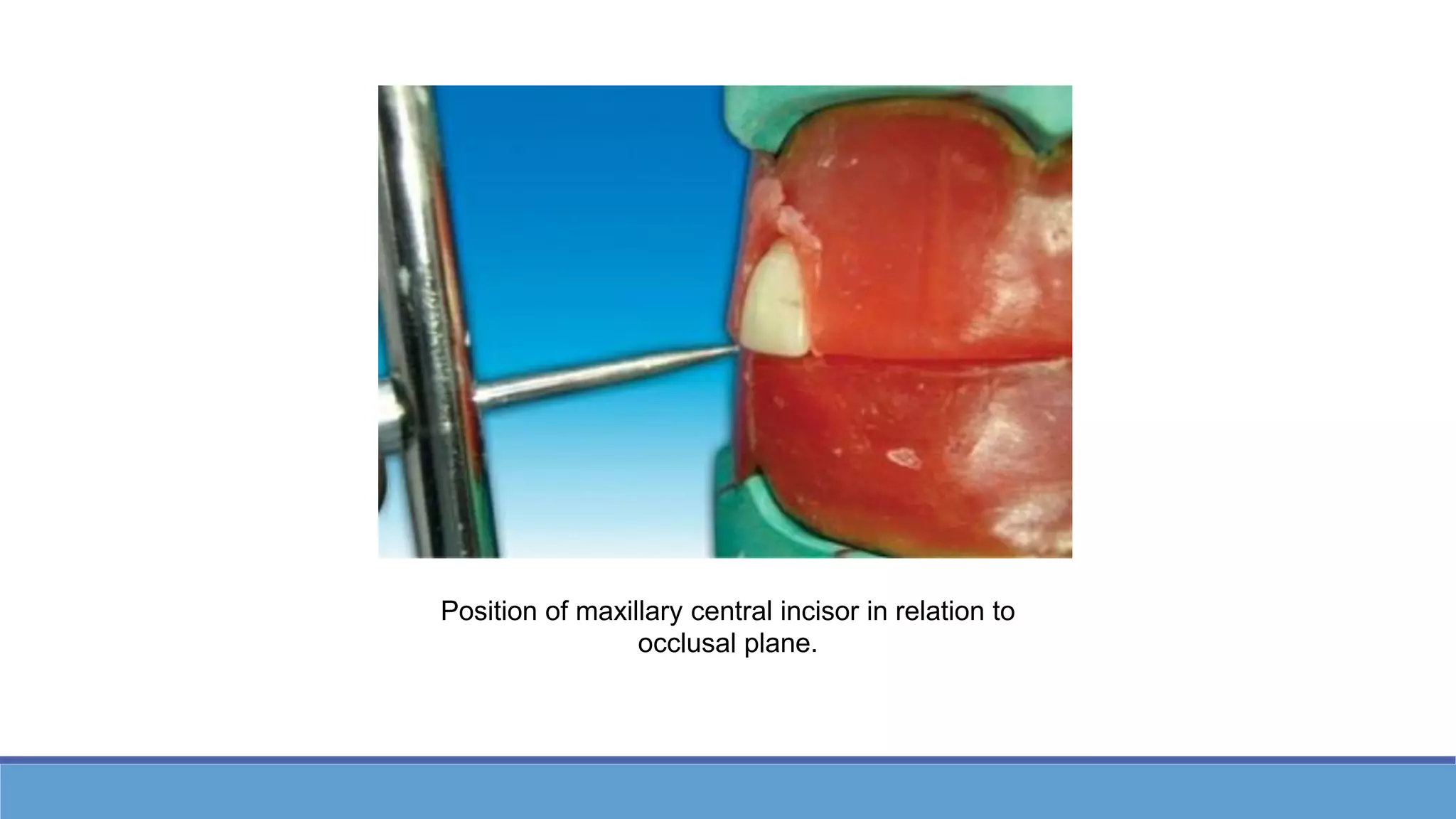 Anterior Teeth Arrangement | PDF