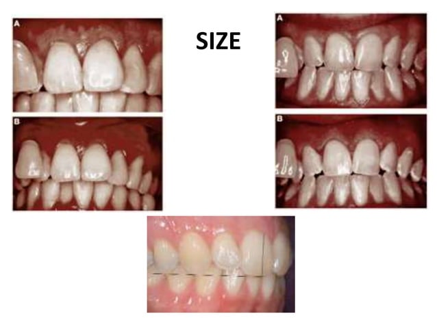Anterior teeth selection | PPTX | Dental Health | Diseases and Conditions