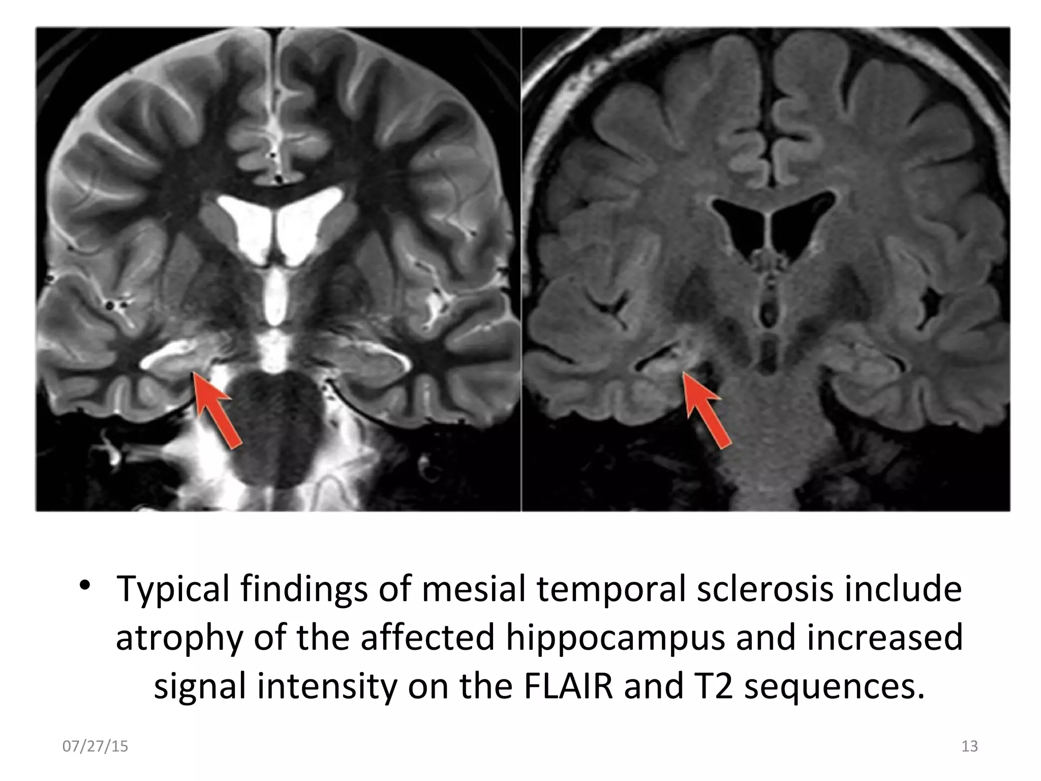 Anterior temporal lobectomy | PPT