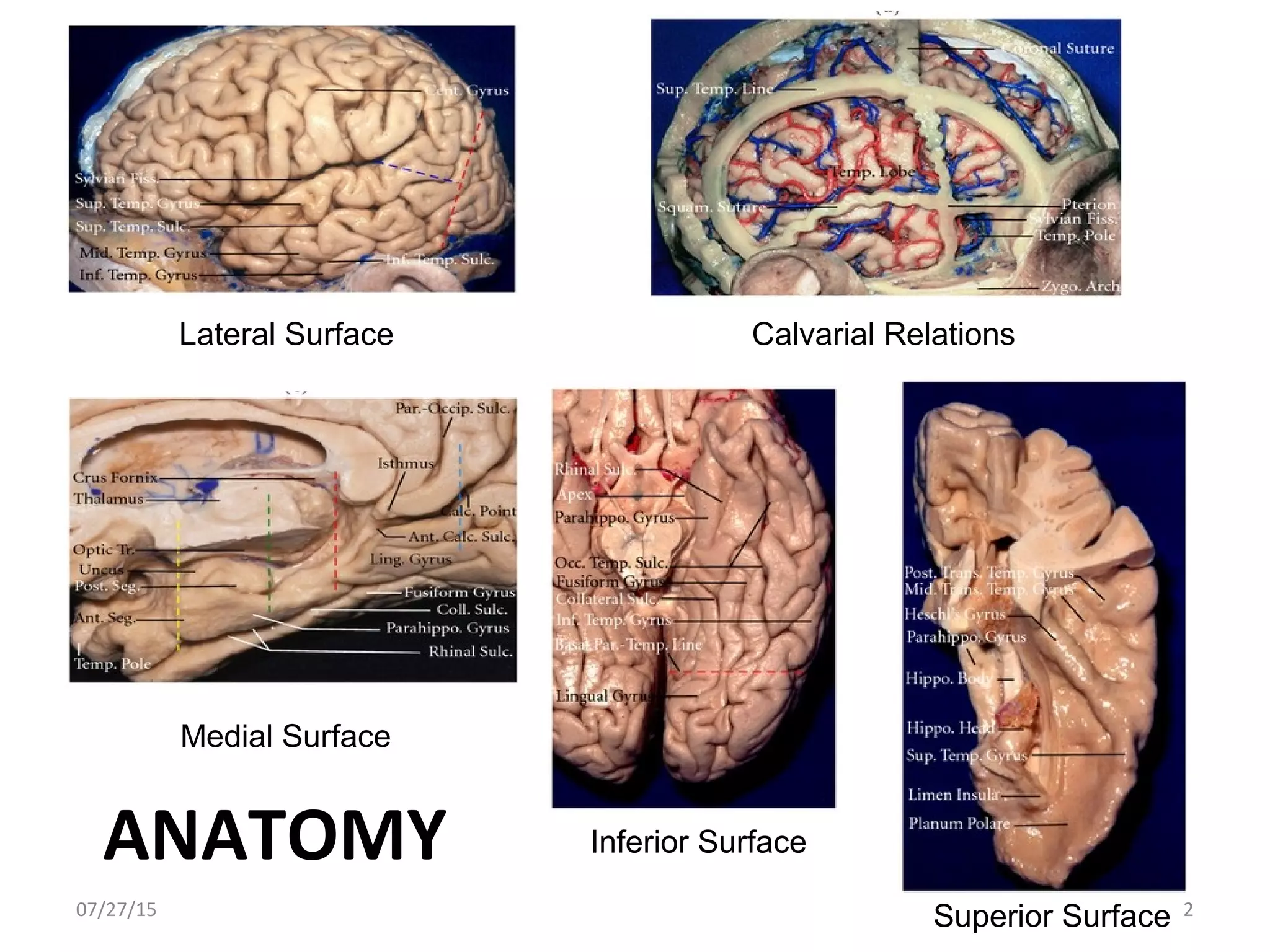 Anterior temporal lobectomy | PPT