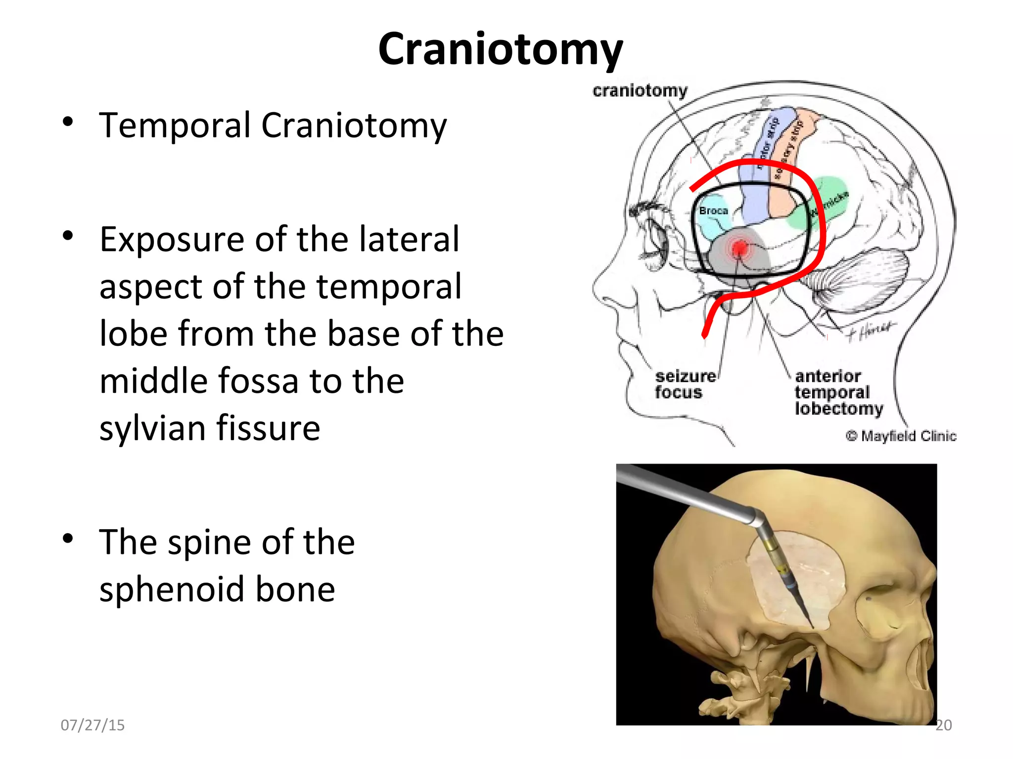 Anterior temporal lobectomy | PPT