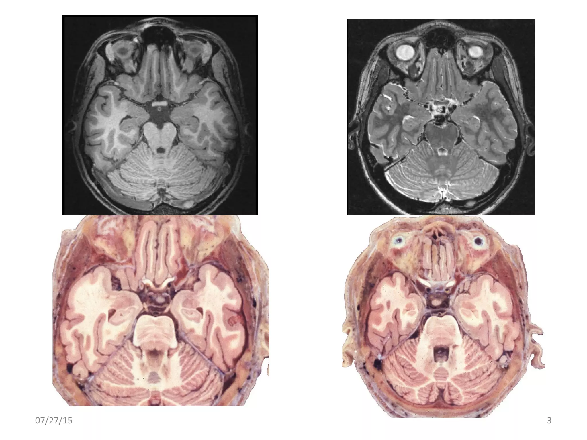 Anterior temporal lobectomy | PPT