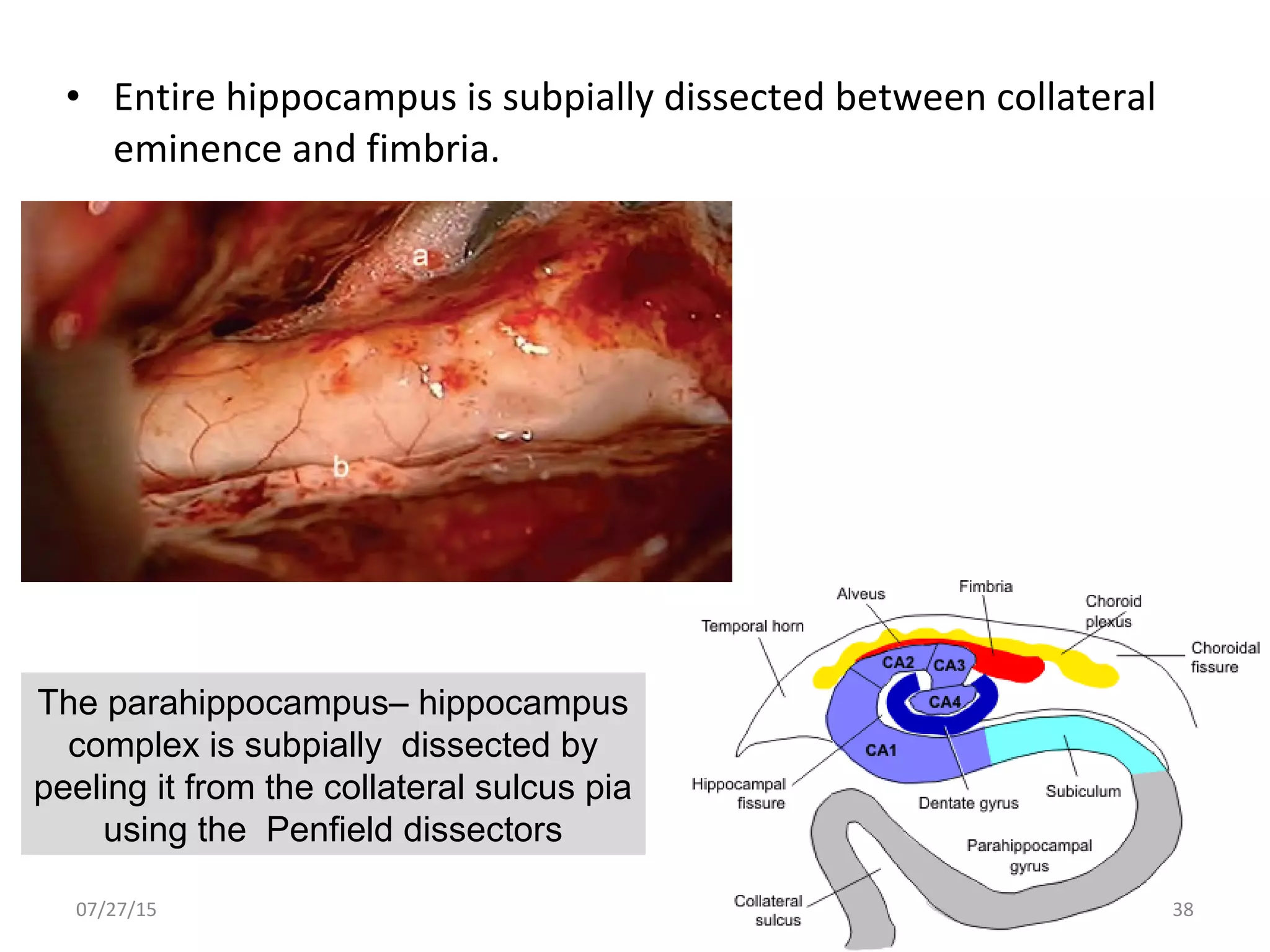 Anterior temporal lobectomy | PPT