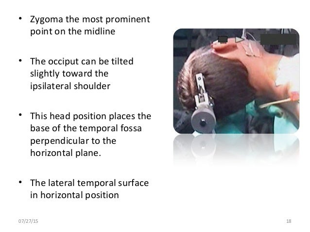 Anterior temporal lobectomy