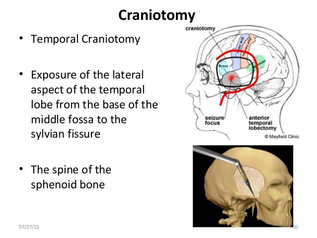 Anterior temporal lobectomy