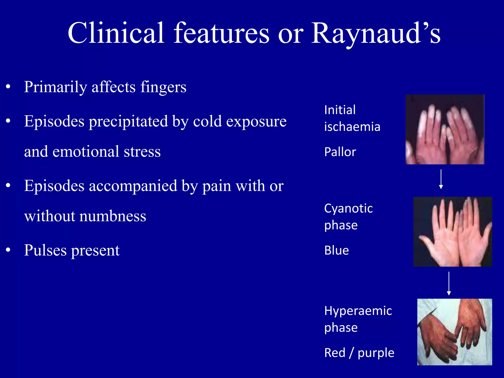 ANTERIOR TIBIAL SYNDROME AND REYNAUD''S DISEASE | PPT