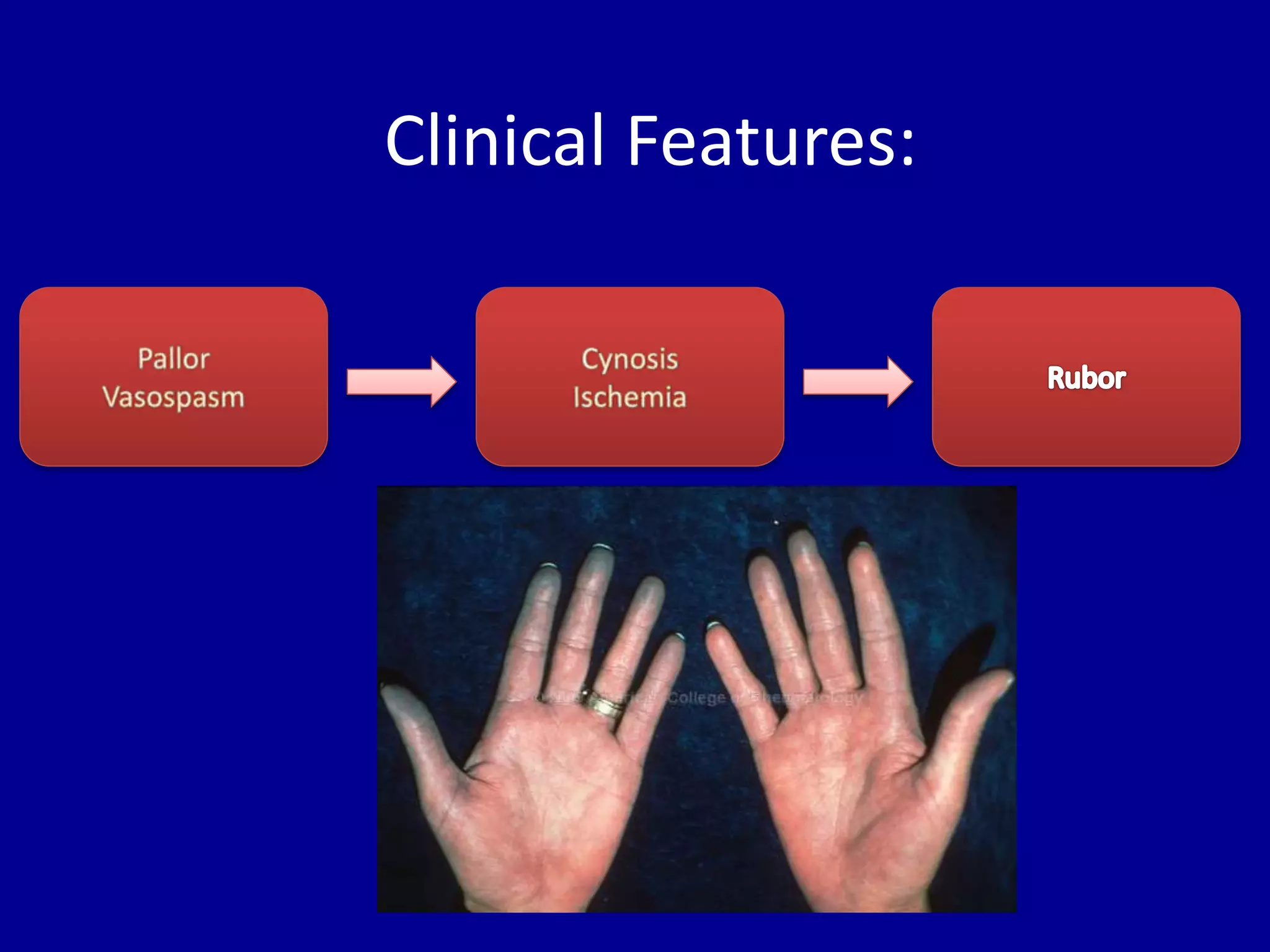 ANTERIOR TIBIAL SYNDROME AND REYNAUD''S DISEASE | PPT