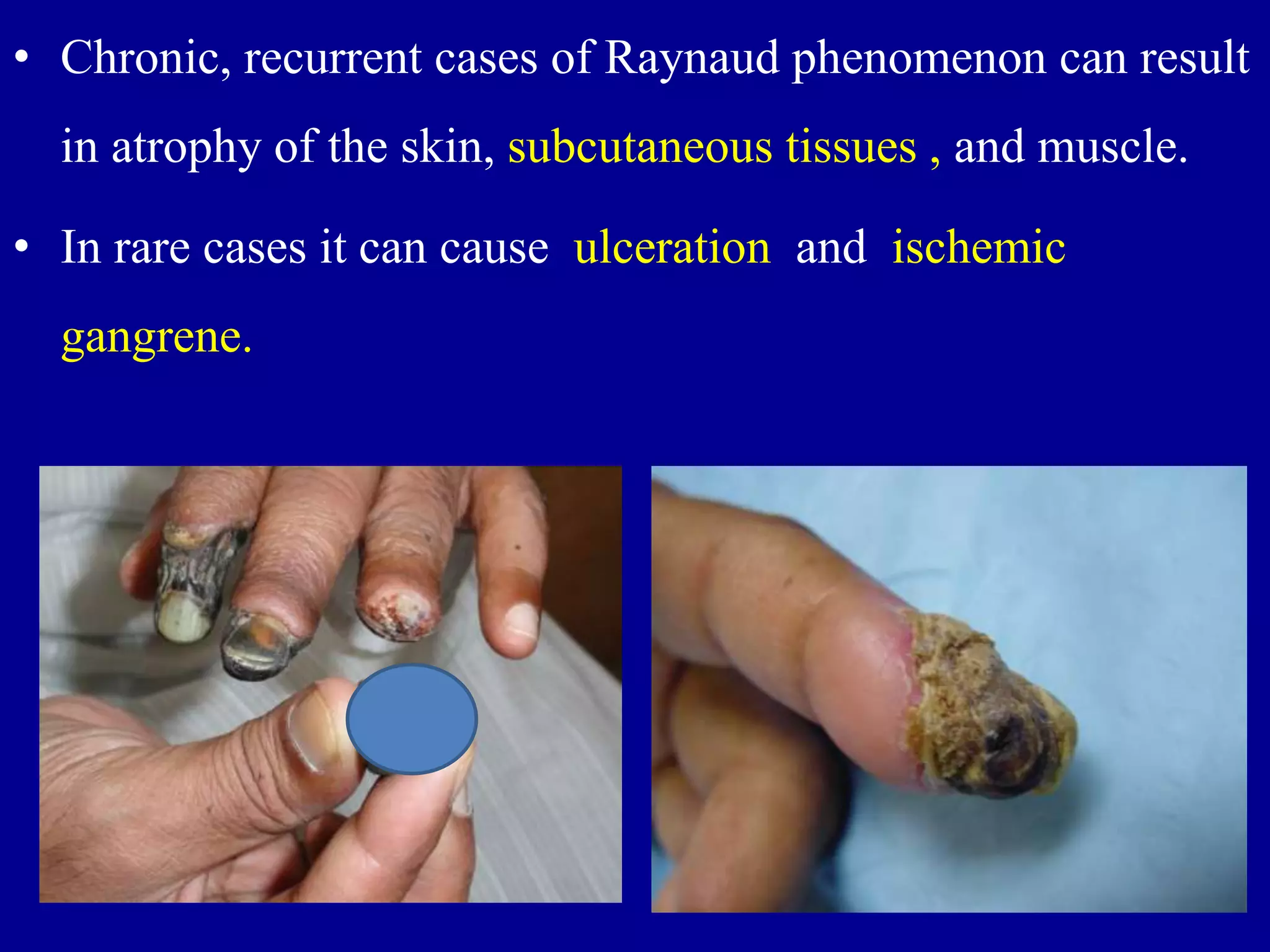 ANTERIOR TIBIAL SYNDROME AND REYNAUD''S DISEASE | PPT