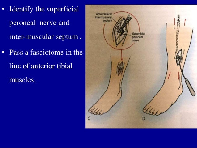 ANTERIOR TIBIAL SYNDROME AND REYNAUD''S DISEASE