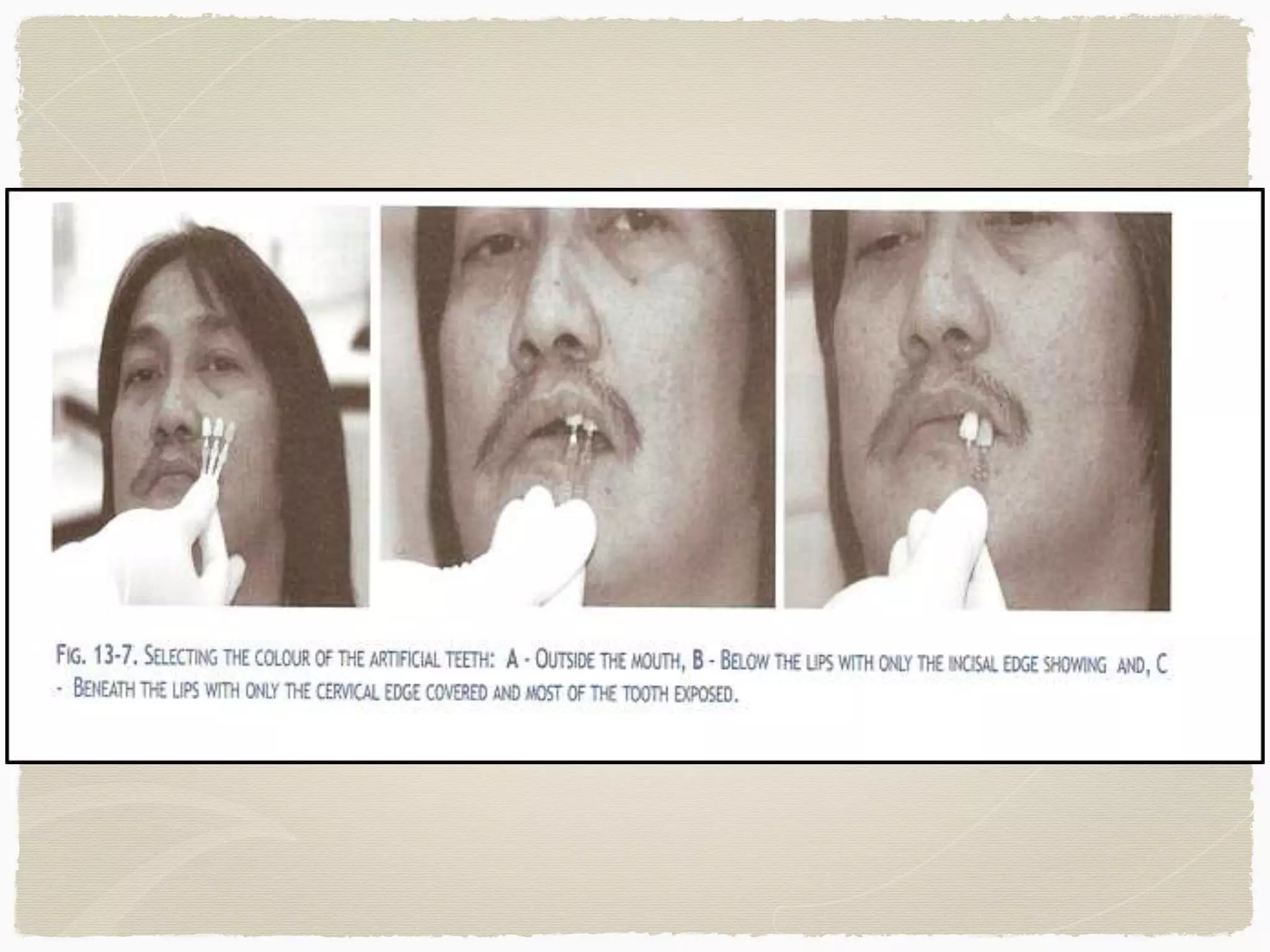 Anterior tooth selection | PPTX