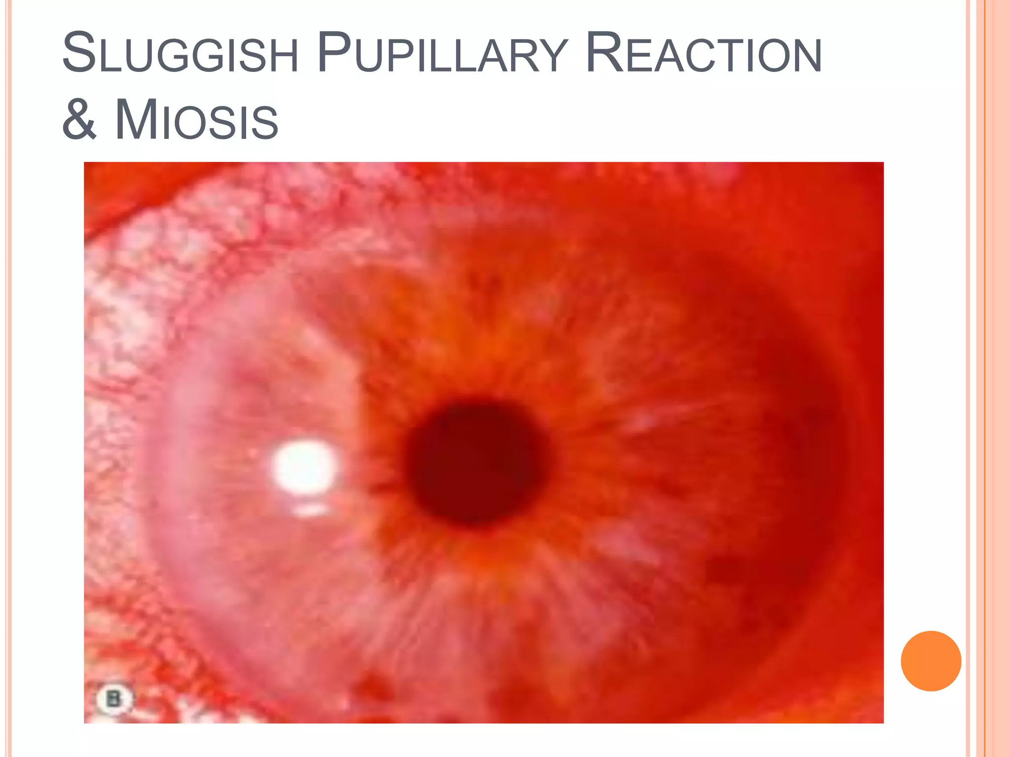 Anterior Uveitis Pptx