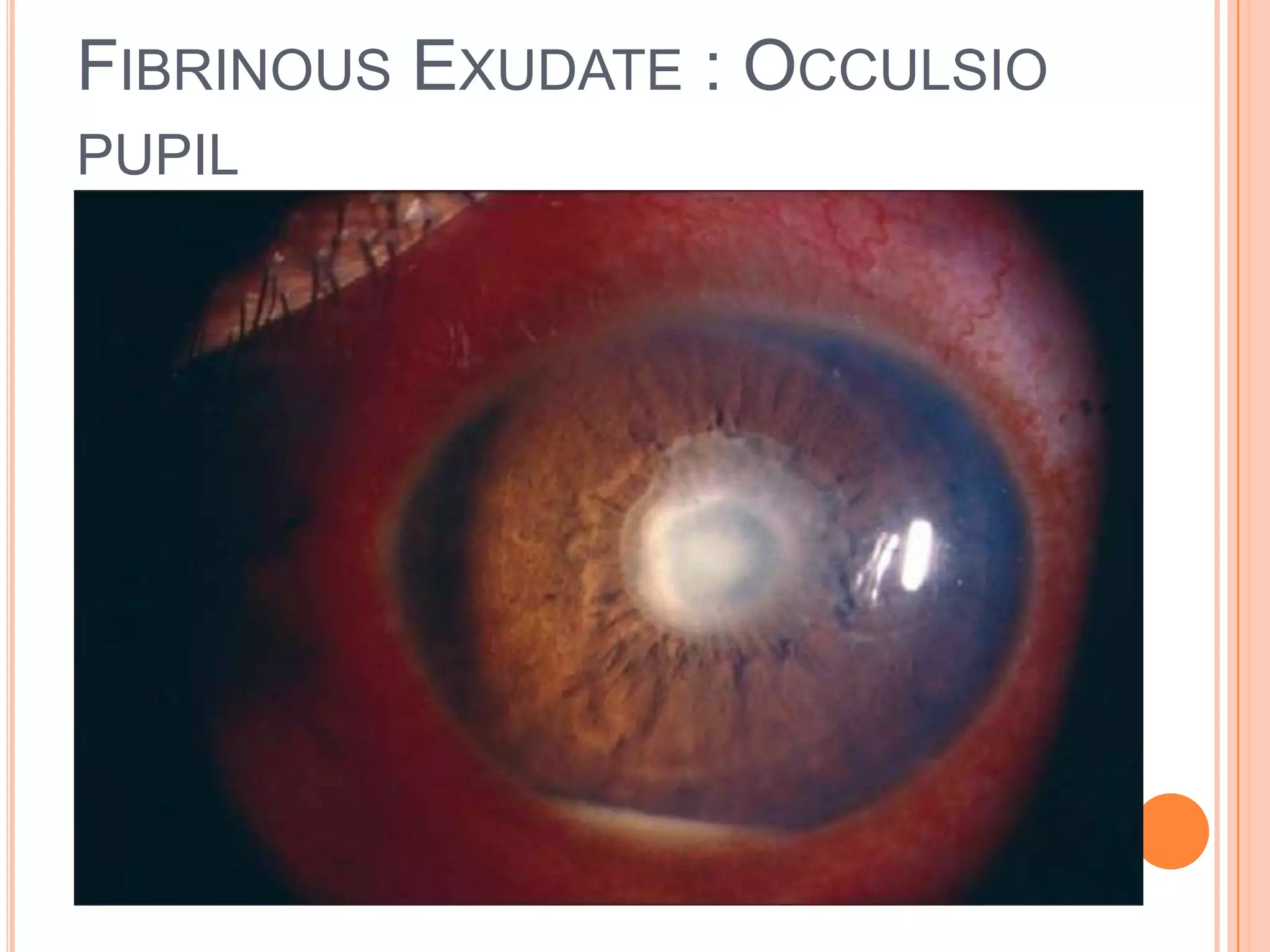 Anterior uveitis | PPTX
