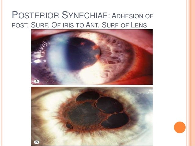Anterior uveitis