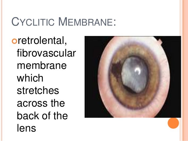Anterior uveitis