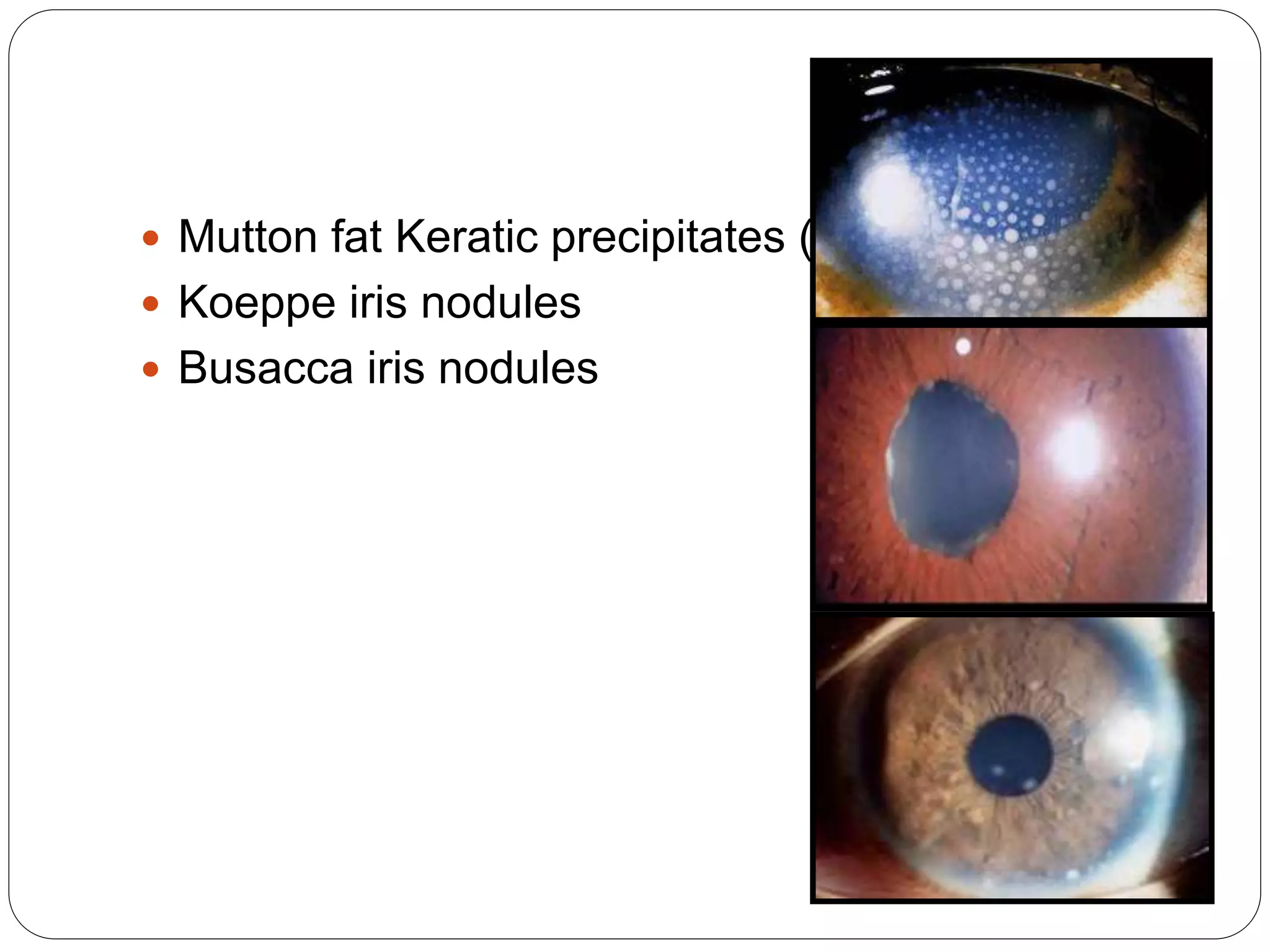 Anterior uveitis | PPTX