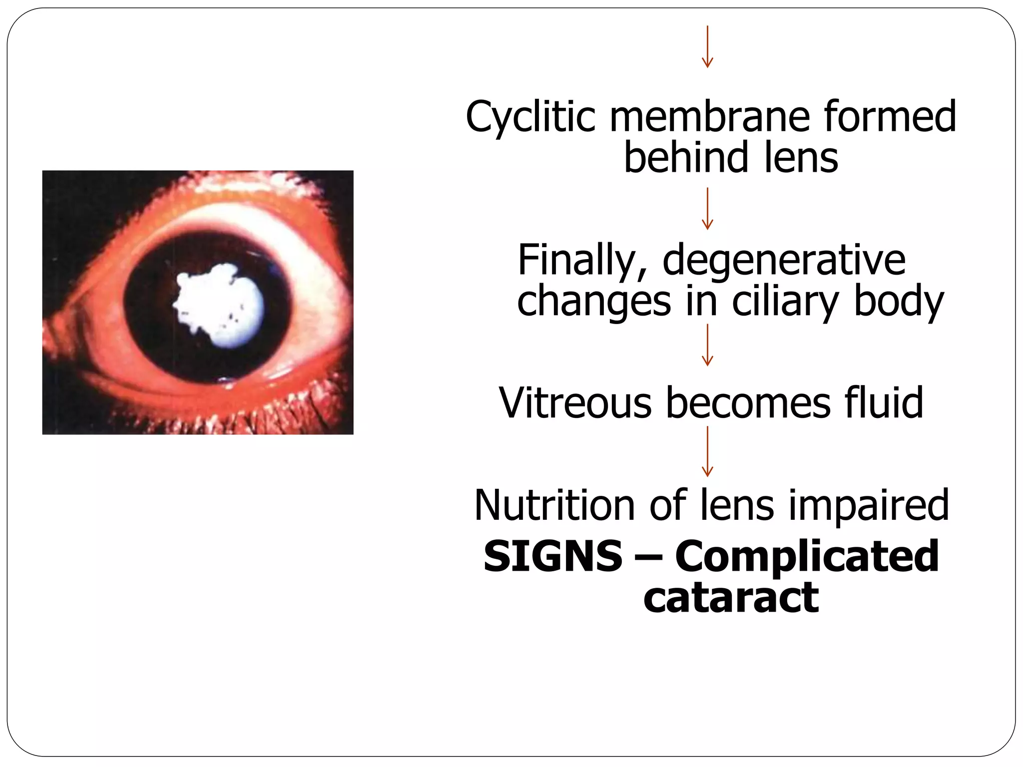 Anterior uveitis | PPTX