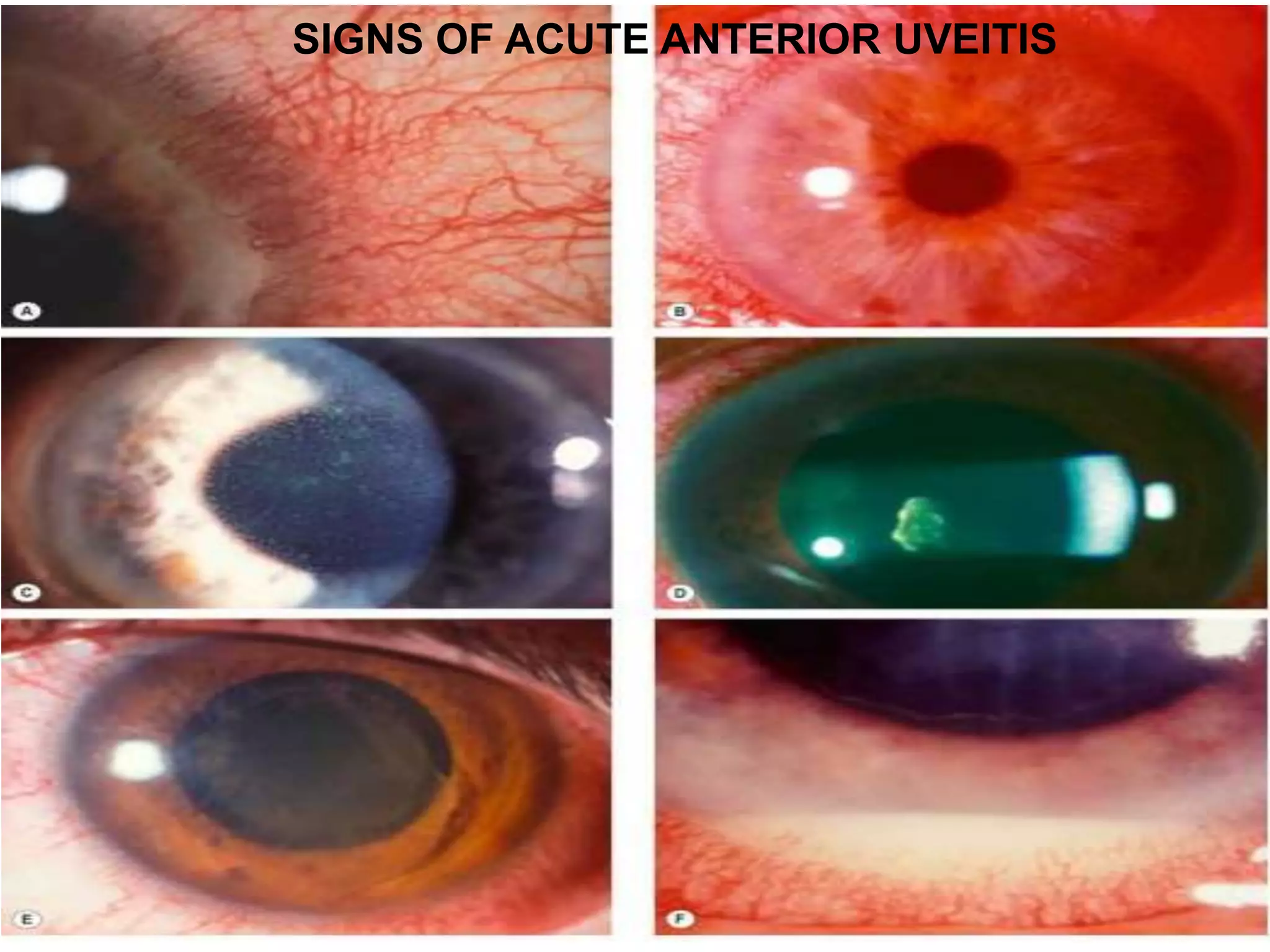 Anterior uveitis | PPTX