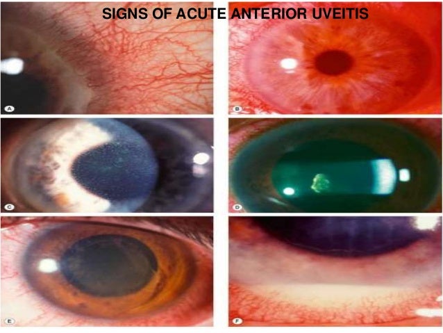 Anterior uveitis