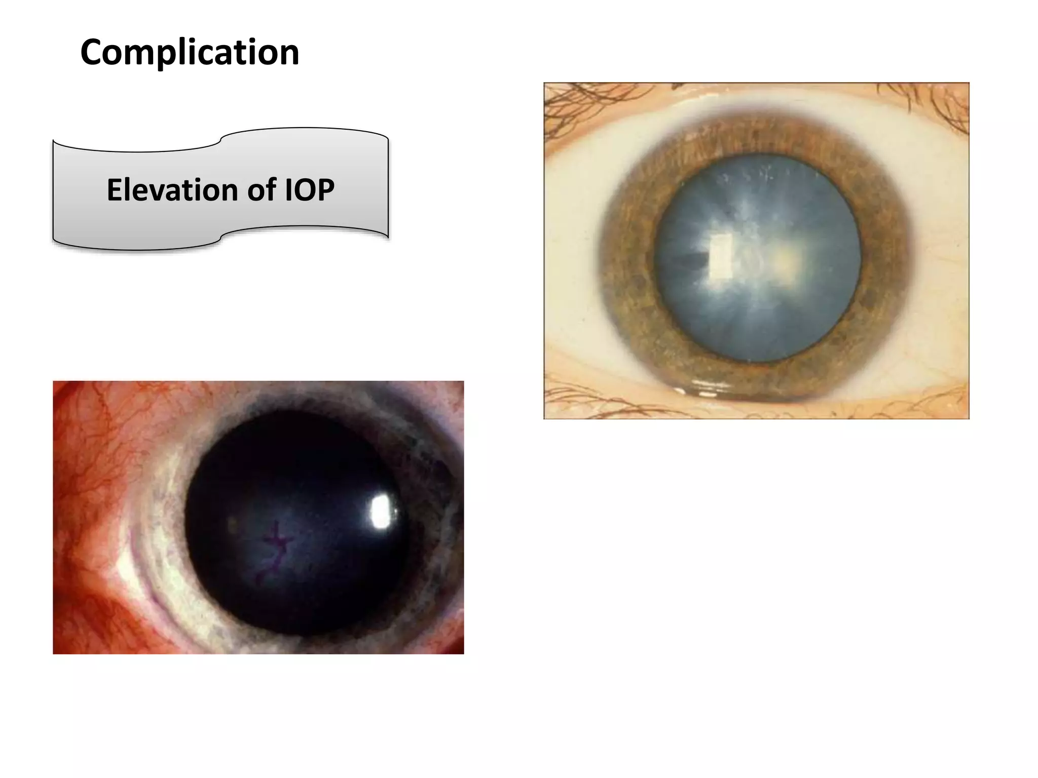 clinical case presentation on anterior uveitis | PPTX