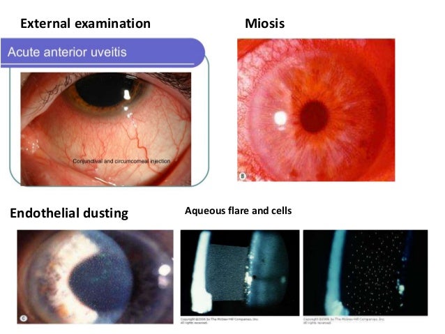 clinical case presentation on anterior uveitis