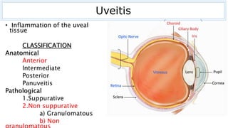 Anterior UVEitis.pptx