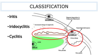 Anterior UVEitis.pptx