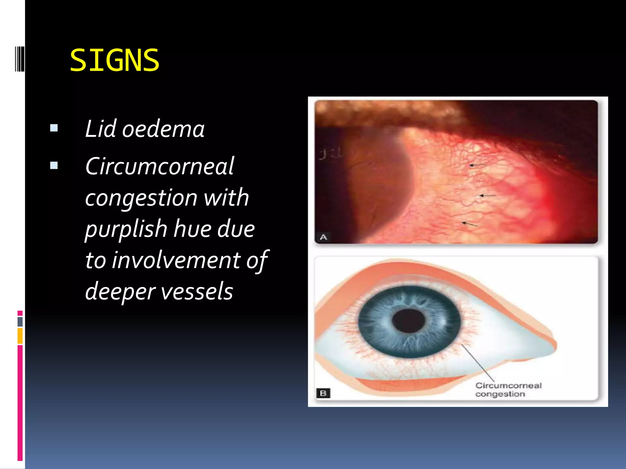 Anterior uveitis.pptx