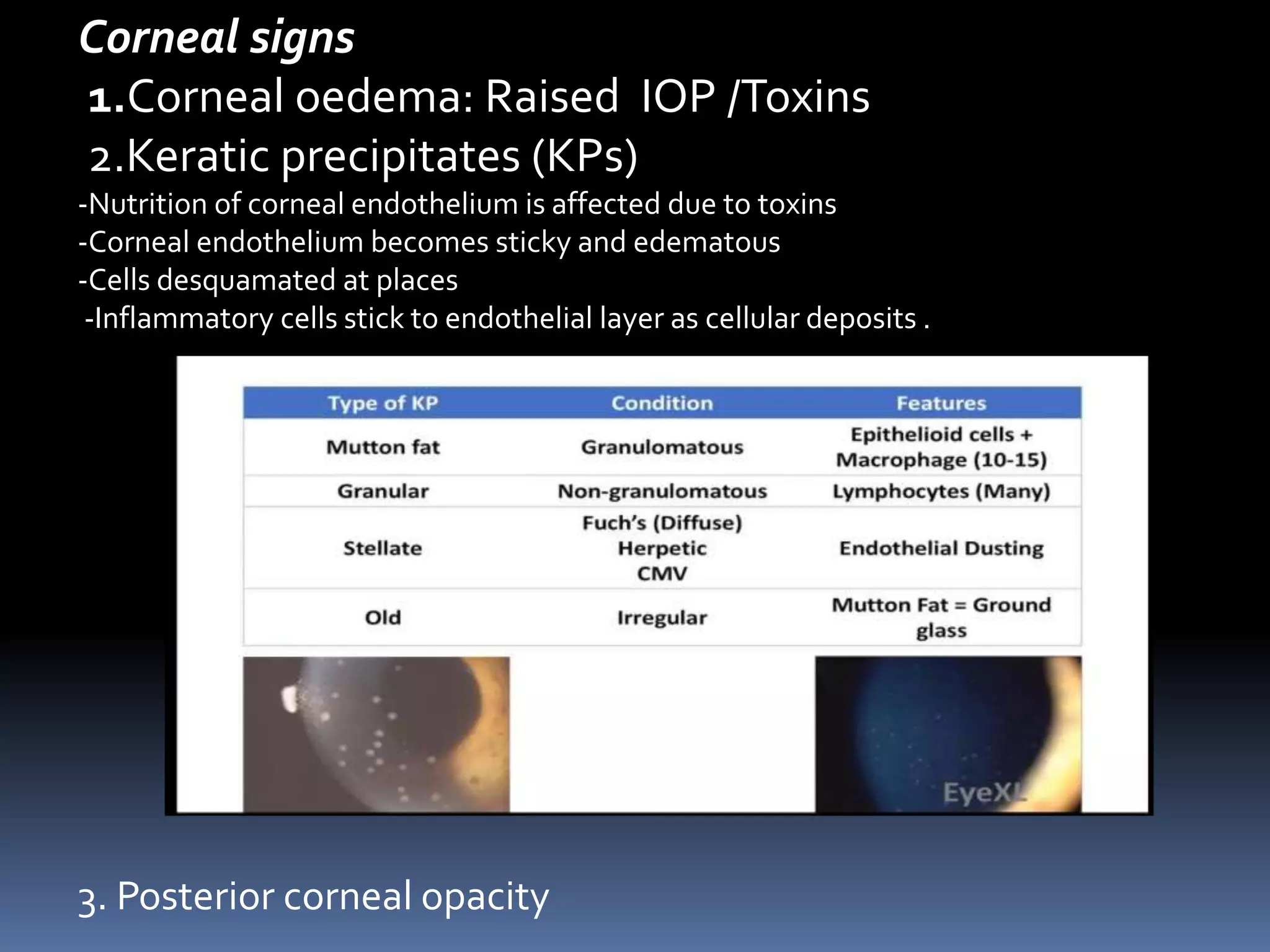 Anterior uveitis.pptx
