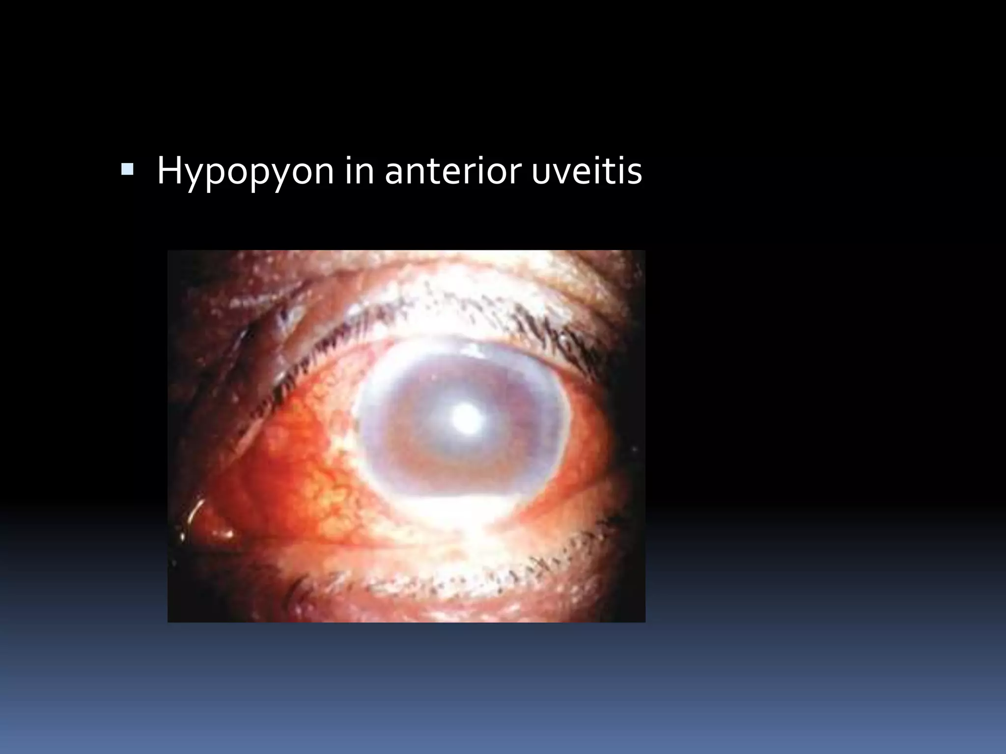 Anterior uveitis.pptx