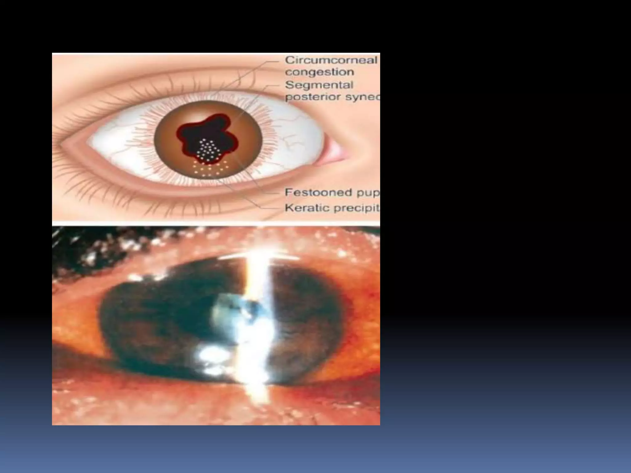 Anterior uveitis.pptx