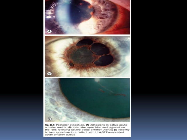 Anterior uveitis.pptx | Eye and Vision Conditions | Diseases and Conditions