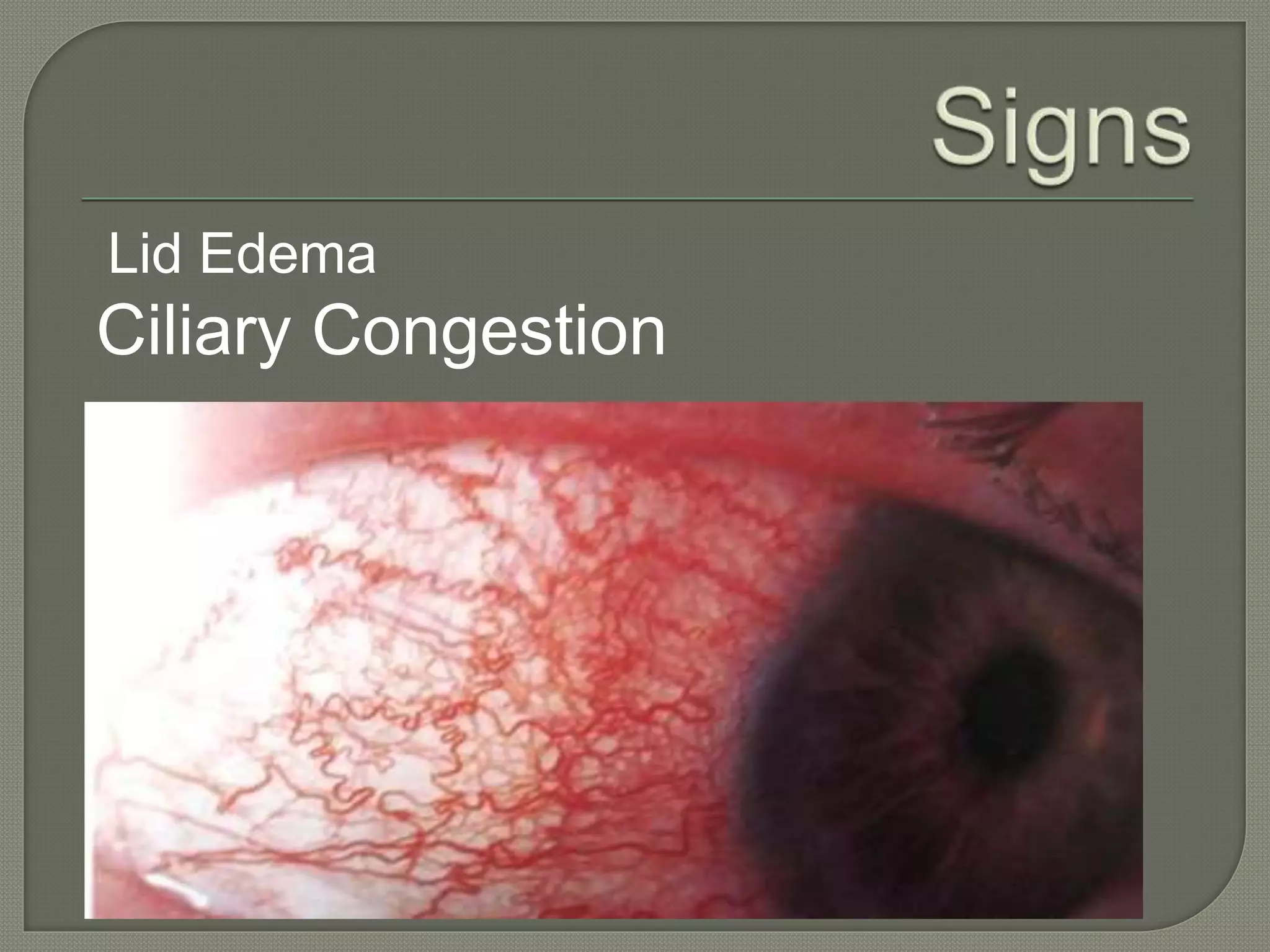 Anterior uveitis.pptx