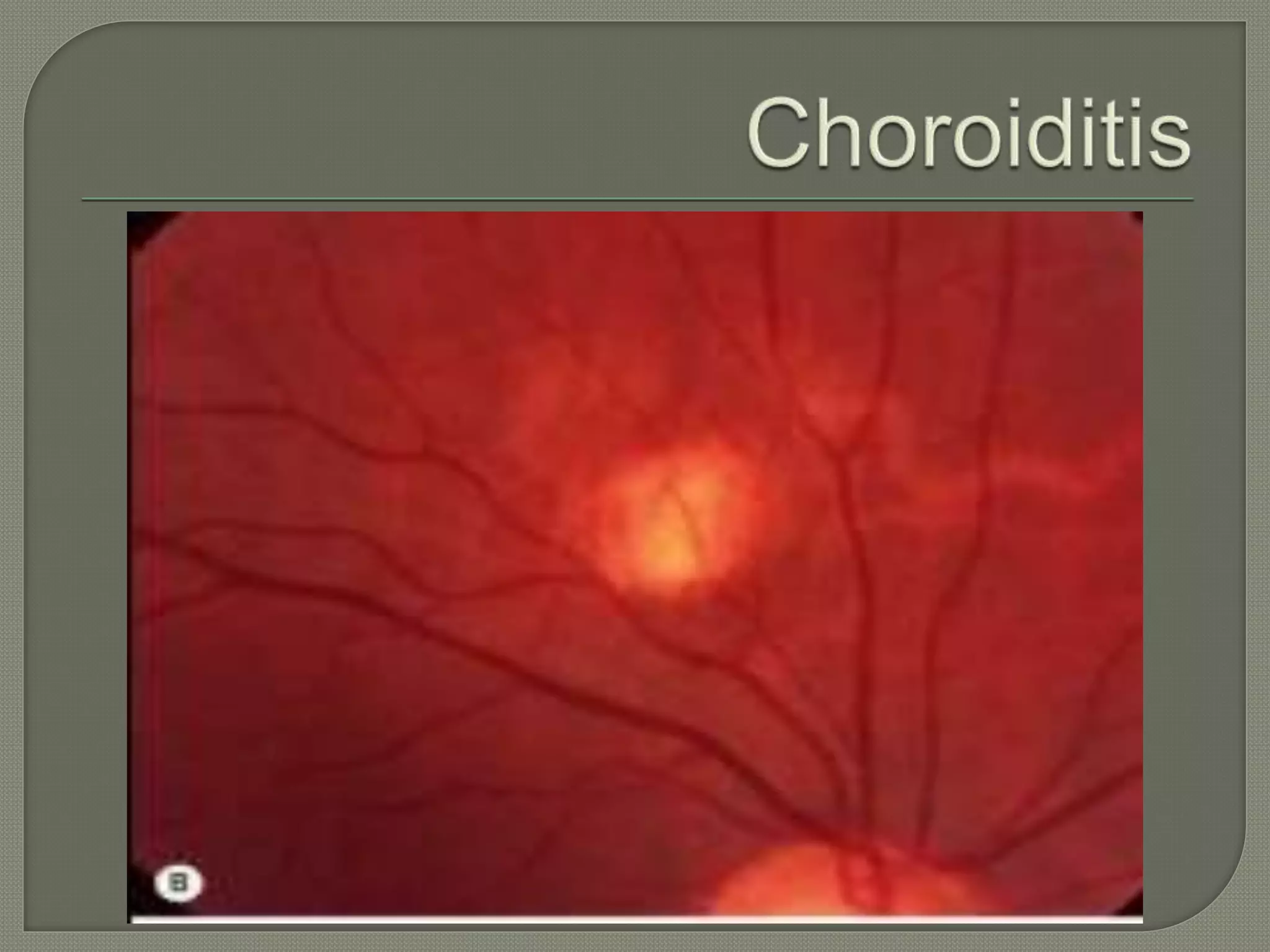 Anterior uveitis.pptx