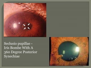 Anterior uveitis.pptx