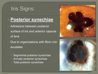 Anterior uveitis.pptx