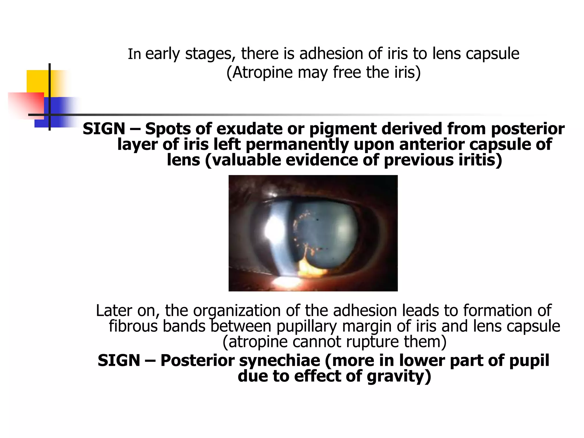 anterior uveitis.pptx