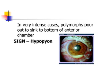anterior uveitis.pptx