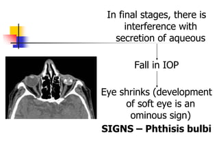 anterior uveitis.pptx