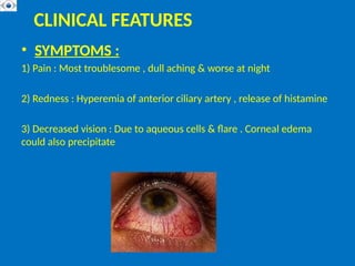 ANTERIOR UVEITIS . CLINICAL FEATURES , DIAGNOSIS , MANAGEMENT | PPTX