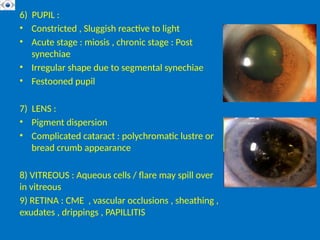 ANTERIOR UVEITIS . CLINICAL FEATURES , DIAGNOSIS , MANAGEMENT | PPTX