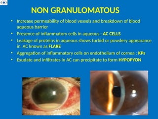 ANTERIOR UVEITIS . CLINICAL FEATURES , DIAGNOSIS , MANAGEMENT | PPTX