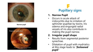 Anterior Uveitis | PPTX