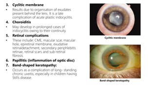 Anterior Uveitis | PPTX