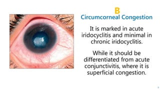 Uveitis Vs Conjunctivitis