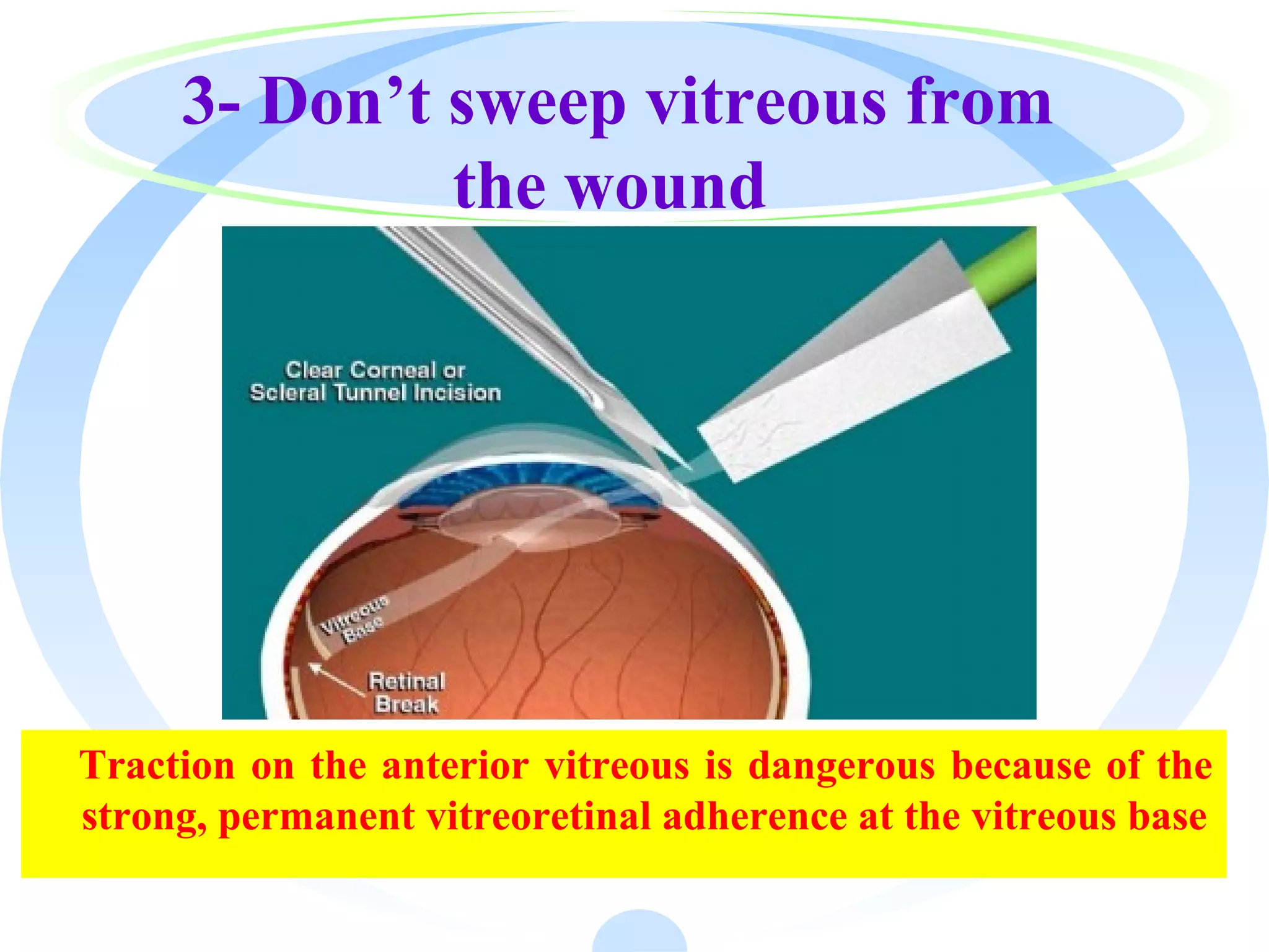 Anterior vitrectomy | PPT